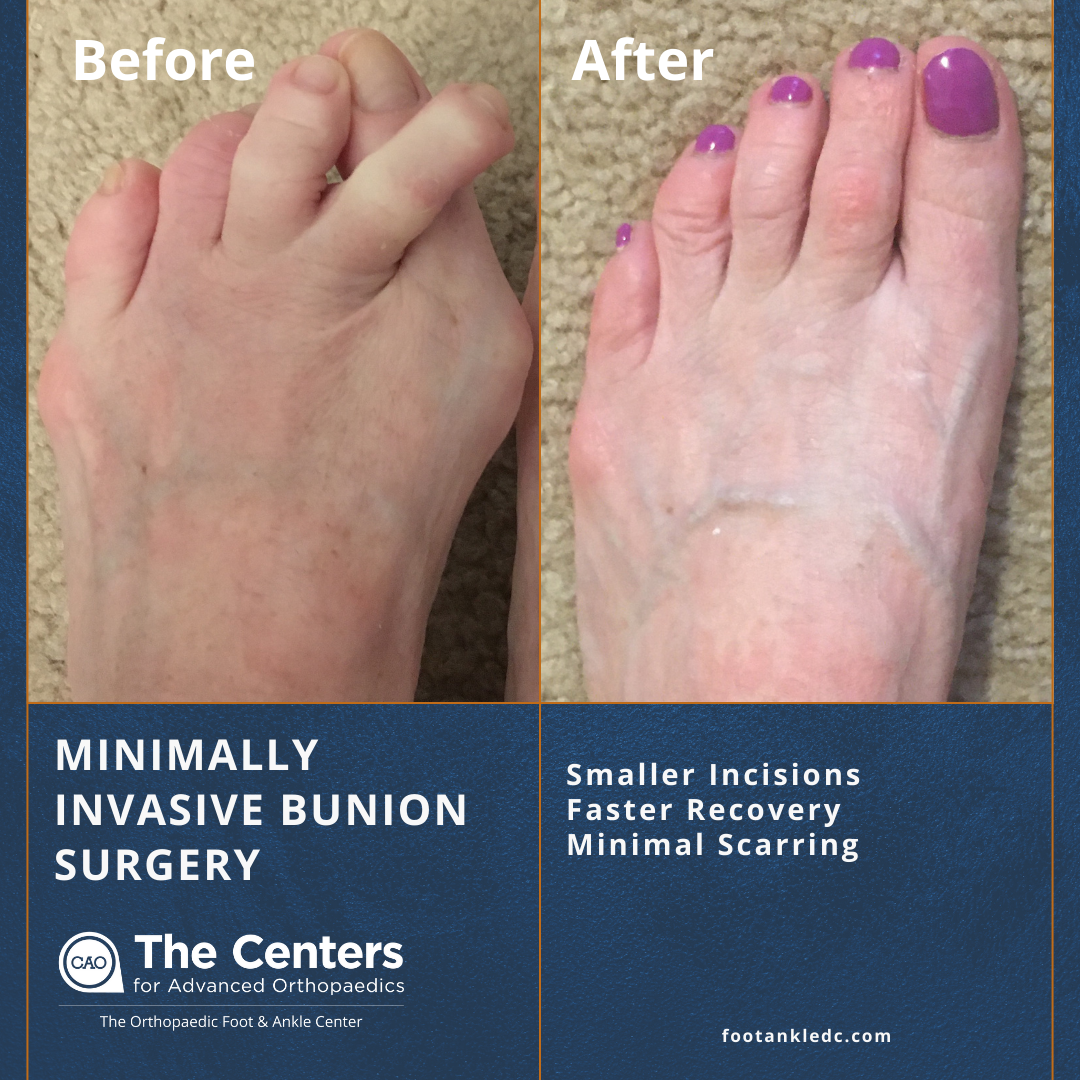 Minimally Invasive Bunion Surgery