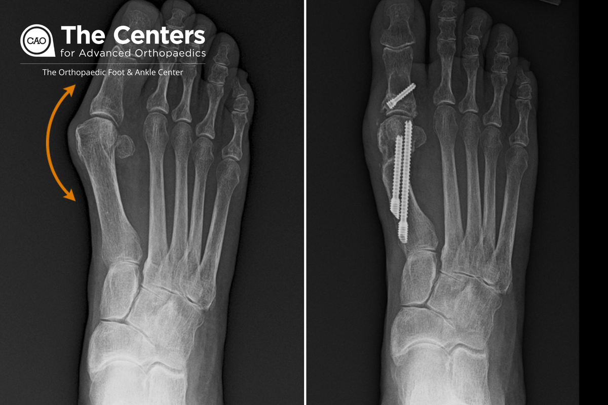 Healing After Minimally Invasive Bunion Surgery: What to Expect