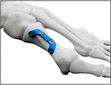 Surgeon's Self-Designed Bunion Plate - A Giant Step Forward in Mobility ...