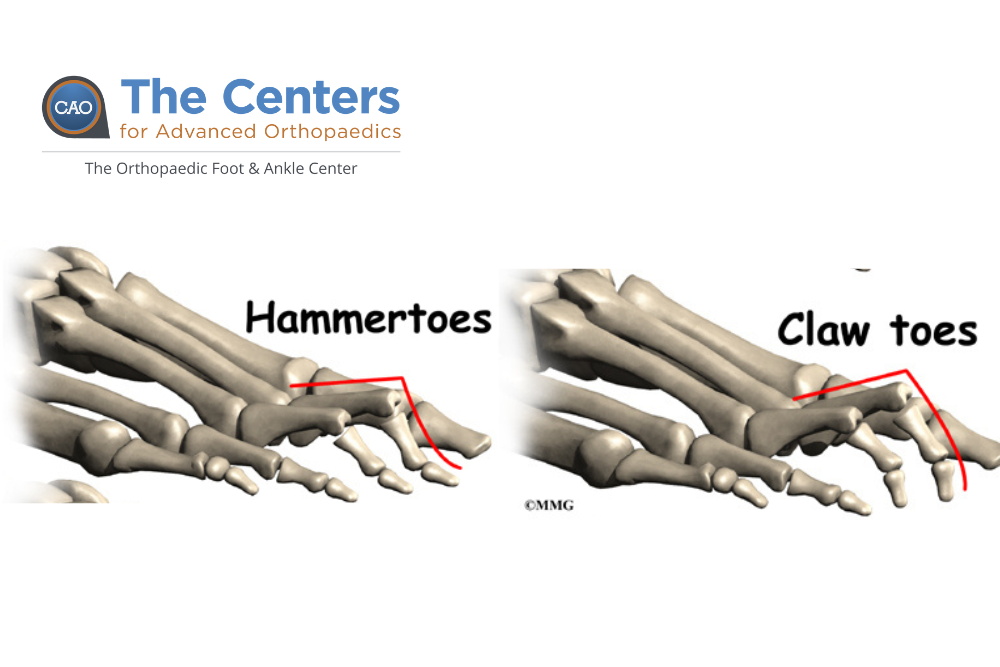 Understanding Toe Deformities: Hammertoe & Claw Toe