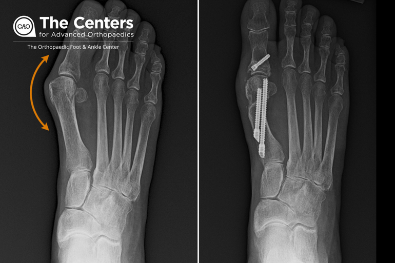 Healing After Minimally Invasive Bunion Surgery: What to Expect