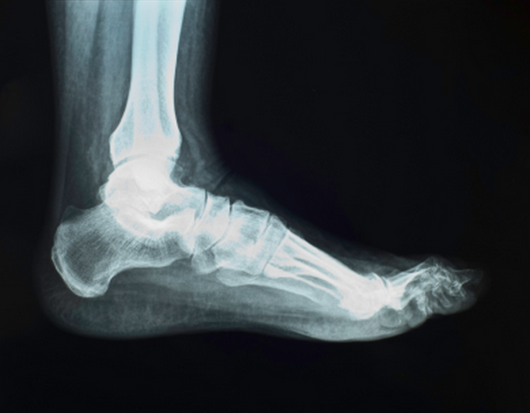 Aching Feet? Get In Step: Orthopaedic Foot & Ankle Center: Foot and ...