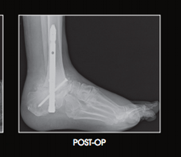 Dr. Neufeld’s Vilex FUZE: Orthopaedic Foot & Ankle Center: Foot and ...
