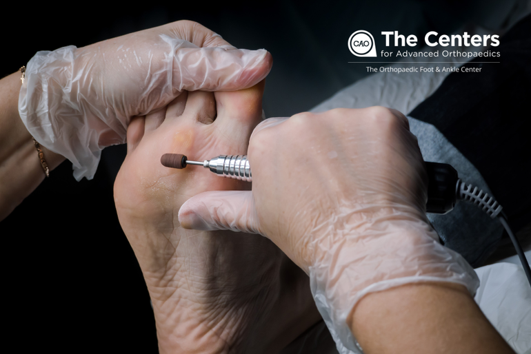 Why Do Corns and Calluses Form?